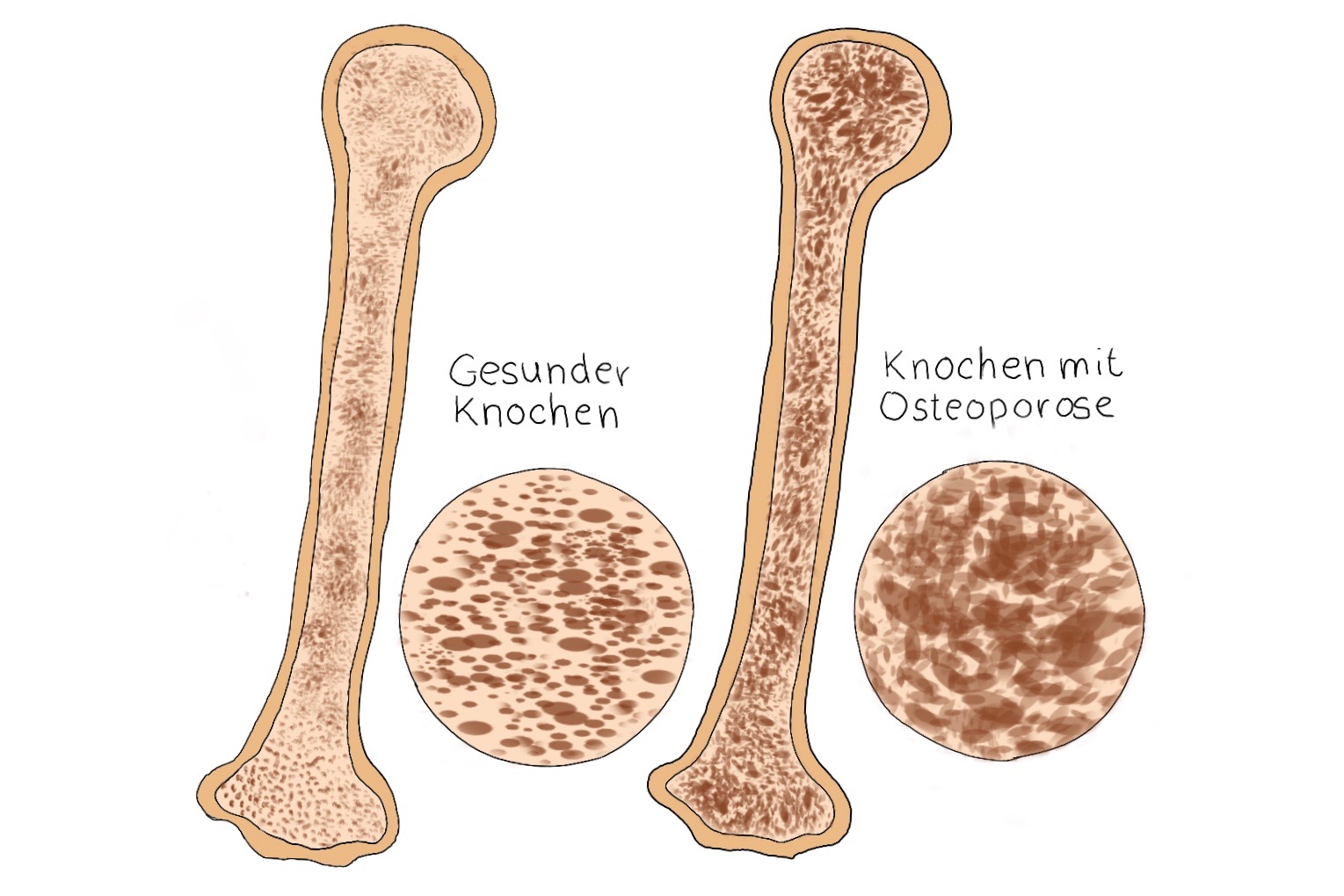Osteoporose – Physiotherapie & Osteopathie Beger | Leipzig Böhlitz-Ehrenberg